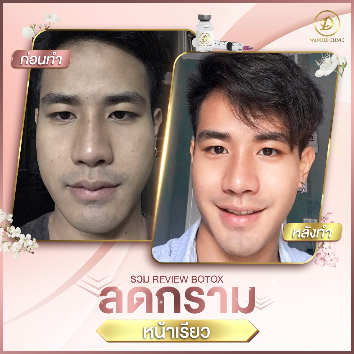 Botox Hugel ดีไหม ต่างกับโบท็อกซ์ยี่ห้ออื่นอย่างไร ? – คลินิก กรุงเทพ